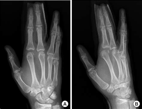 Figure 1 From Complex Dorsal Dislocation Of The Metacarpophalangeal
