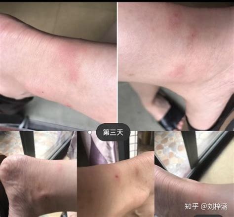 被毒蚊子咬了怎么办？怎么快速消肿止痒 知乎