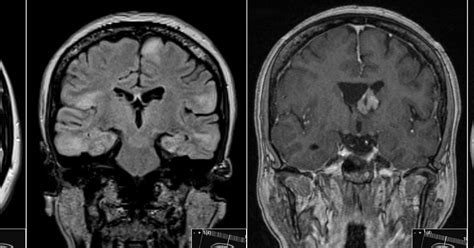 Tuberous Sclerosis