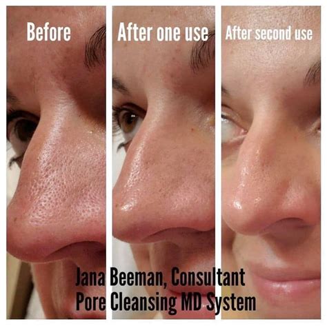 Clogged Pores On Face