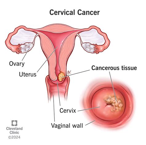 Cervical Cancer Symptomscauses And Prevention Of Cervical Cancer