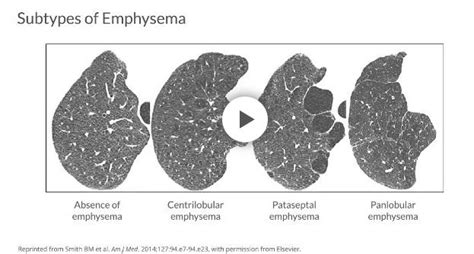 Interstitial Lung Disease And Emphysema Lungs