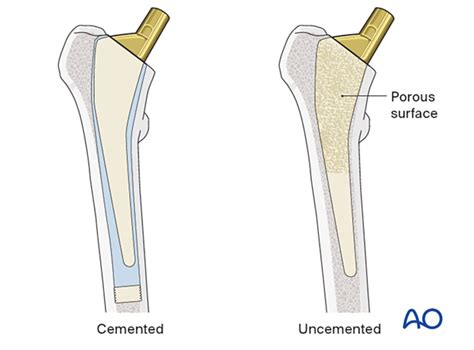Total Hip Arthroplasty For Displaced Subcapital Femoral Neck Fractures
