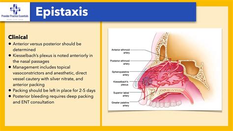 Epistaxis Management