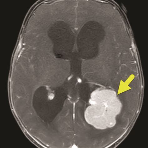 Choroid Plexus Papilloma Applied Radiology