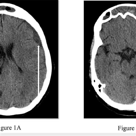 Pdf Subdural Empyema Secondary To Severe Paranasal Sinusitis