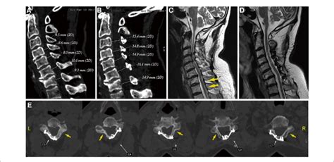 Ab Preoperative And Postoperative Sagittal Ct Scans Illustrating
