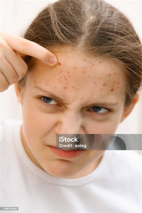 여드름을 가진 십대 소녀의 얼굴 그녀는 거울에 자신을보고 그녀의 손으로 그녀의 얼굴을 만지고 피부에 여드름 아름다움과 건강의 개념 갈색 머리에 대한 스톡 사진 및 기타