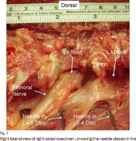Figure 2 From Lumbar Plexus Anatomy Within The Psoas Muscle Implications For The Transpsoas