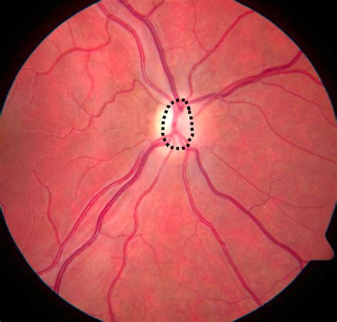 Optic Nerve Hypoplasia