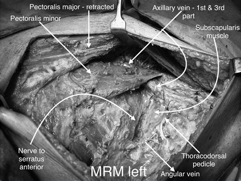 Subbiah S On Linkedin Breast Cancer Management Is Becoming More And More Conservative And We Dont…
