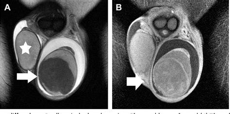 Figure 12 From Mr Imaging Of Scrotum Semantic Scholar