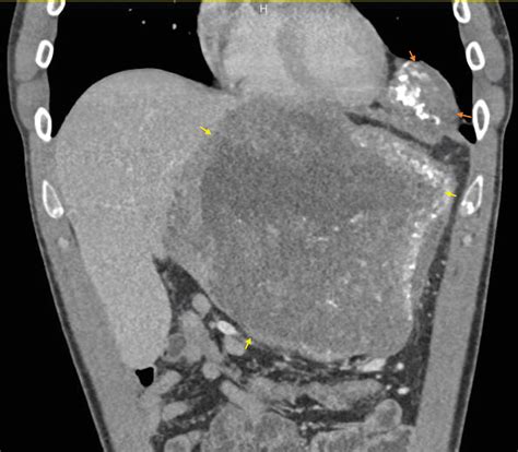 Figure 1 From Rare Case Of Multifocal Alveolar Echinococcosis