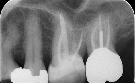 Calcified Root Canals Andy Tsai Endodontics