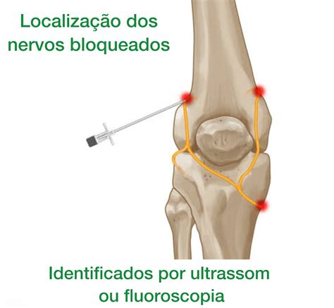 Bloqueio Dos Nervos Geniculares No Joelho Dr Thiago Protta