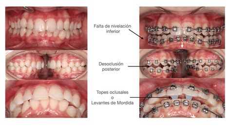 ¿qué Es Un Tope Oclusal Luis González Ortodoncia