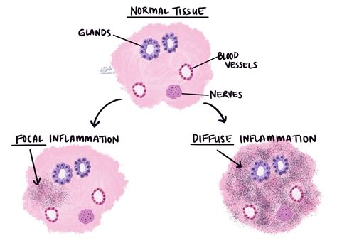 Diffuse Mypathologyreport