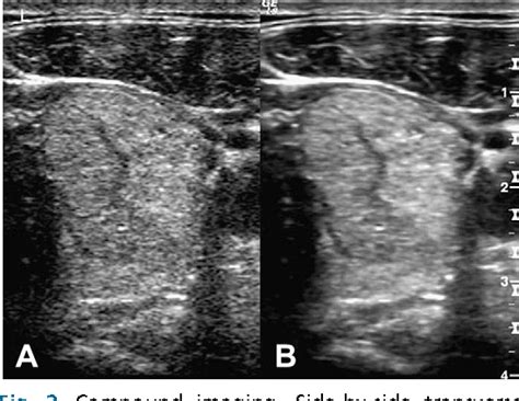 Table 1 From Thyroid Ultrasound Part 1 Technique And Diffuse Disease