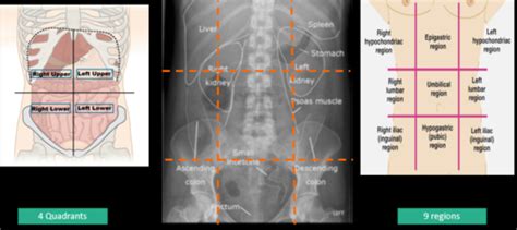 AP Abdomen X Ray Image Evaluation And Interpretation Flashcards Quizlet