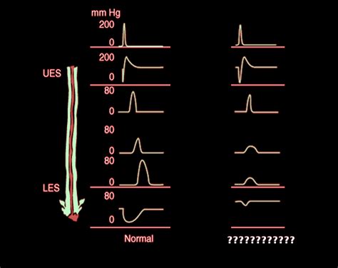 Diffuse Esophageal Spasm Manometry