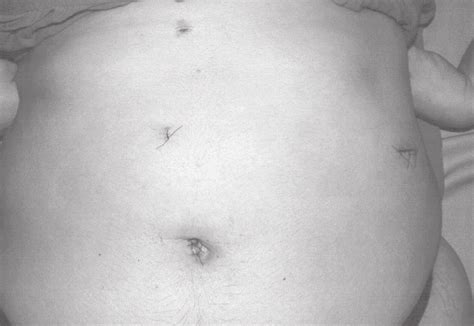 Trocar Placement For Laparoscopic Splenectomy 1 A 10 Mm Camera