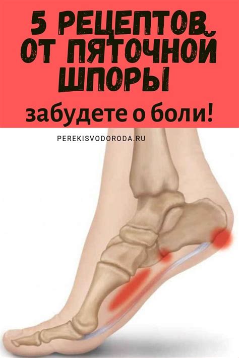 5 рецептов от пяточной шпоры забудете о боли Здоровье Журнал о