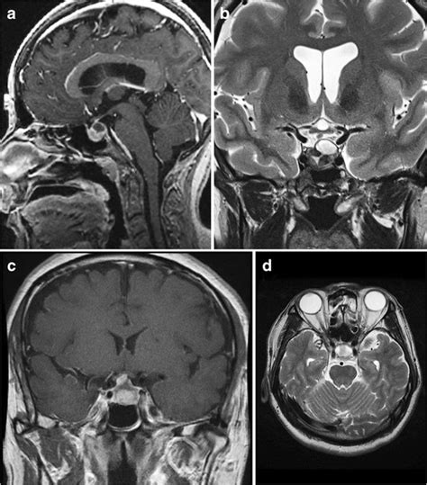 Xanthomatous Hypophysitis Neuroimaging Of Hypophysitis Etiologies And