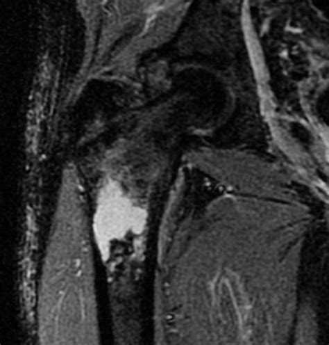 Chondrosarcoma Mri