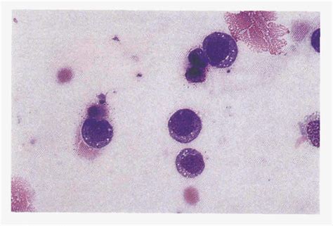 Immunoblastic Large Cell Lymphoma Semantic Scholar