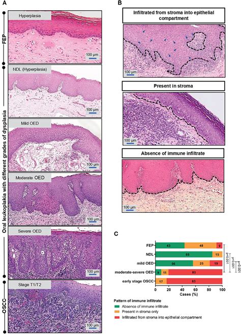 Hairy Leukoplakia Histology