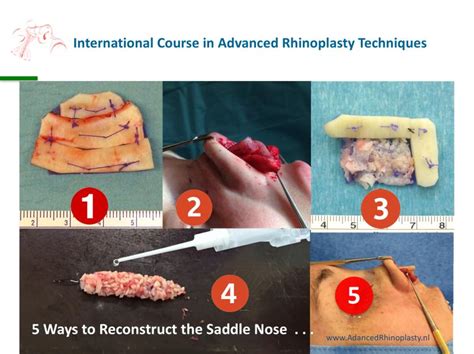 Dirk Jan Menger On Linkedin International Course In Advanced Rhinoplasty Techniques Utrecht The…