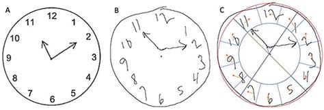 Moca Scoring Nuances With Clock Draw The Patient S Cube Copy And Clock Drawing On The Montreal
