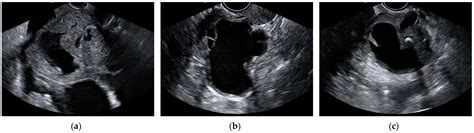 Jcm Free Full Text Enhancing Ovarian Tumor Diagnosis Performance