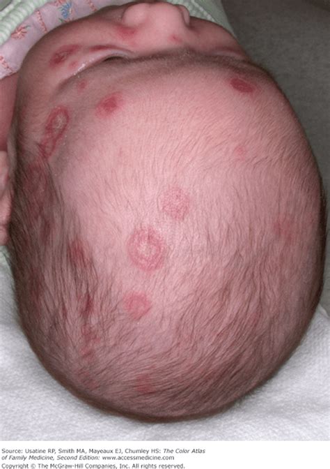 Diaper Rash Lesions At Mariam Oberg Blog