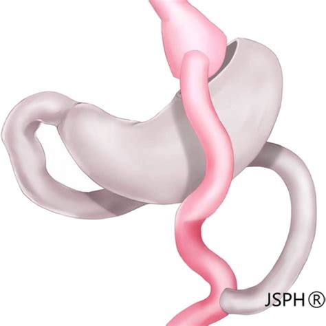 Sleeve Gastrectomy With Jejunojejunal Bypass Download Scientific Diagram