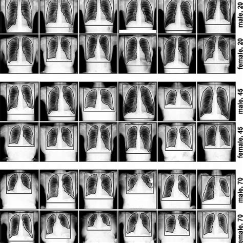 Gender Related Differences In Lung Size And Lung Shape As Revealed By