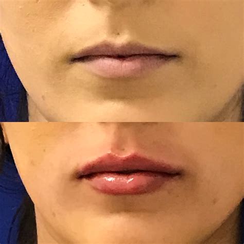 Restylane Kysse To Increase Plumpness And Definition At Artemedica