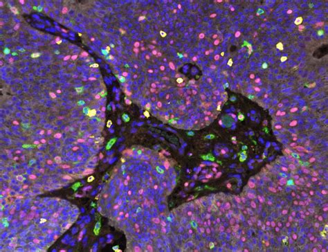 Xavier Berthet On Linkedin The Tumor Microenvironment State Associates With Response To Hpv…