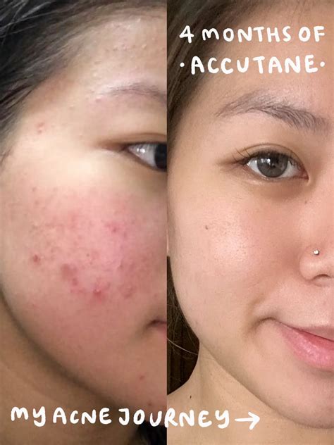 How Accutane Transformed And Cleared My Skin 🤍 แกลเลอรีที่โพสต์โดย