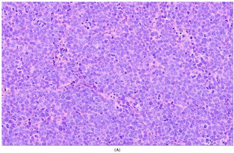 Burkitt Lymphoma—a Guide To Biological Features Diagnosis And