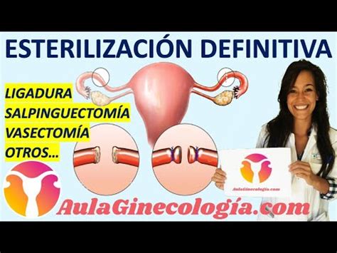 EsterilizaciÓn Definitiva Ligadura De Trompas Y Otras ️ TÉcnica ️
