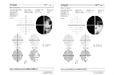 10 2 Humphrey Visual Field Test Ou Report September 2021 Download