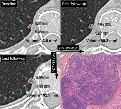 Solid Pulmonary Nodule With Smooth Margins Located In The Right Lower Download Scientific