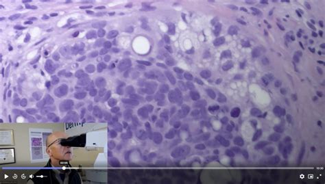 Sebaceous Carcinoma Or Basal Cell Carcinoma With Sebaceous Dermpedia