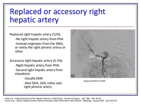 Replaced Hepatic Artery Replaced Left Hepatic Artery Clinical