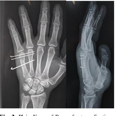Figure 1 From Comparative Study Between Antegrade Intramedullary K