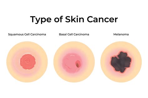 Types Of Skin Cancer Squamous Basal Cell Graphic By Hamjaiu · Creative