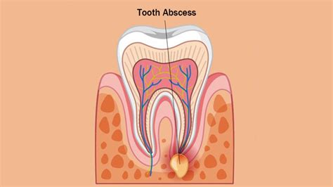 Tooth Abscess Dr Jamilian