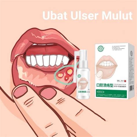 Yaojian Barry Mouth Ulcer Spray Anti Mouth Ulcer Protects Ulcer Wounds