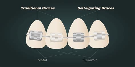 Dental Braces And Aligners Types Cost Procedure And Benefits Apollo Dental